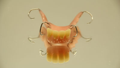 Prothese:Interimsprothese | Dental Studio Feindler GmbH