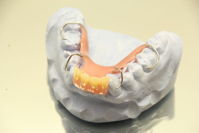 Prothese:Interimsprothese | Dental Studio Feindler GmbH