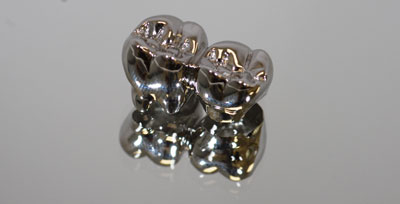 Krone:Vollguss | Dental Studio Feindler GmbH