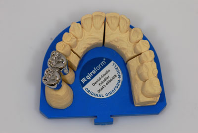 Krone:Vollguss | Dental Studio Feindler GmbH