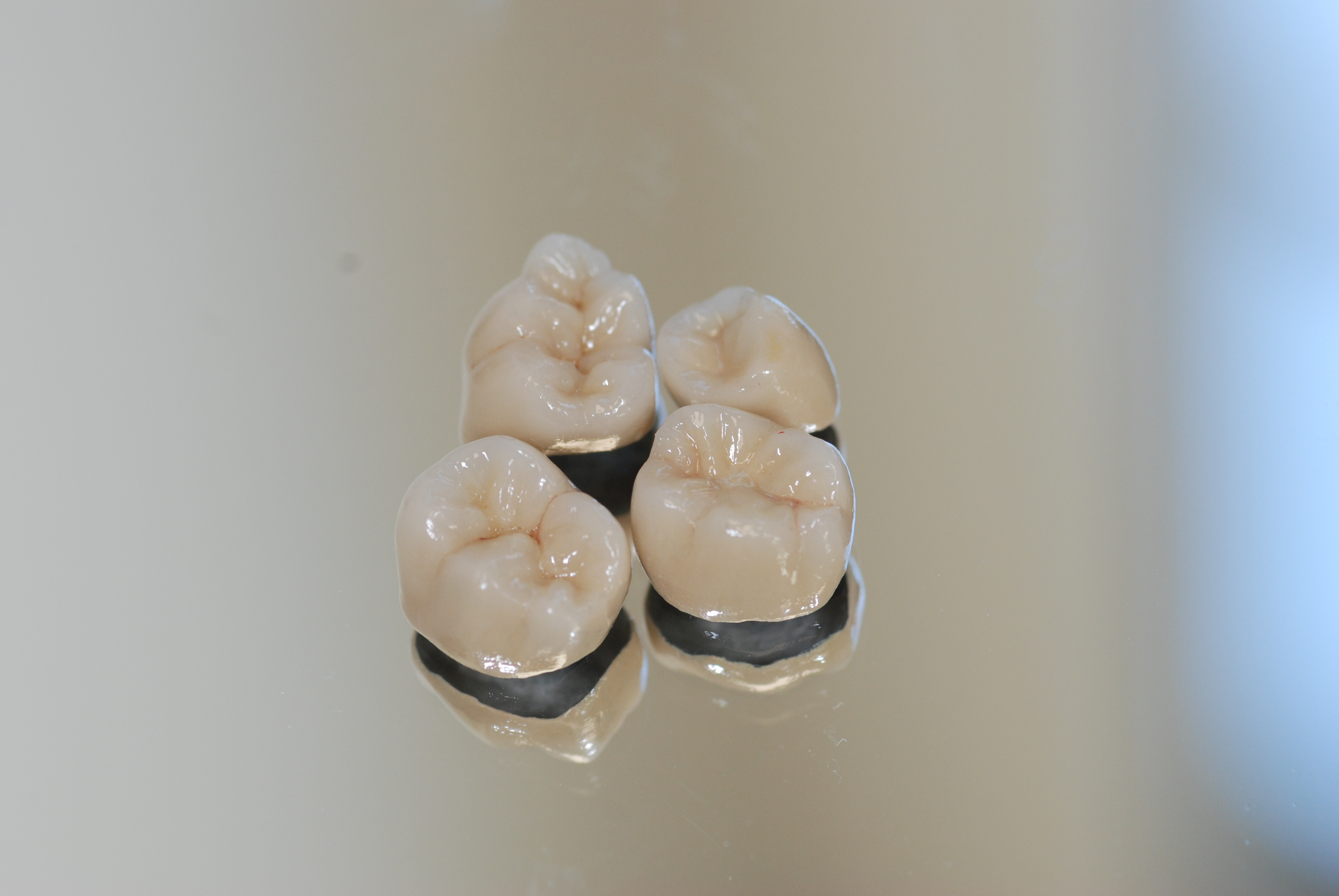 Krone:Vollverblendet | Dental Studio Feindler GmbH