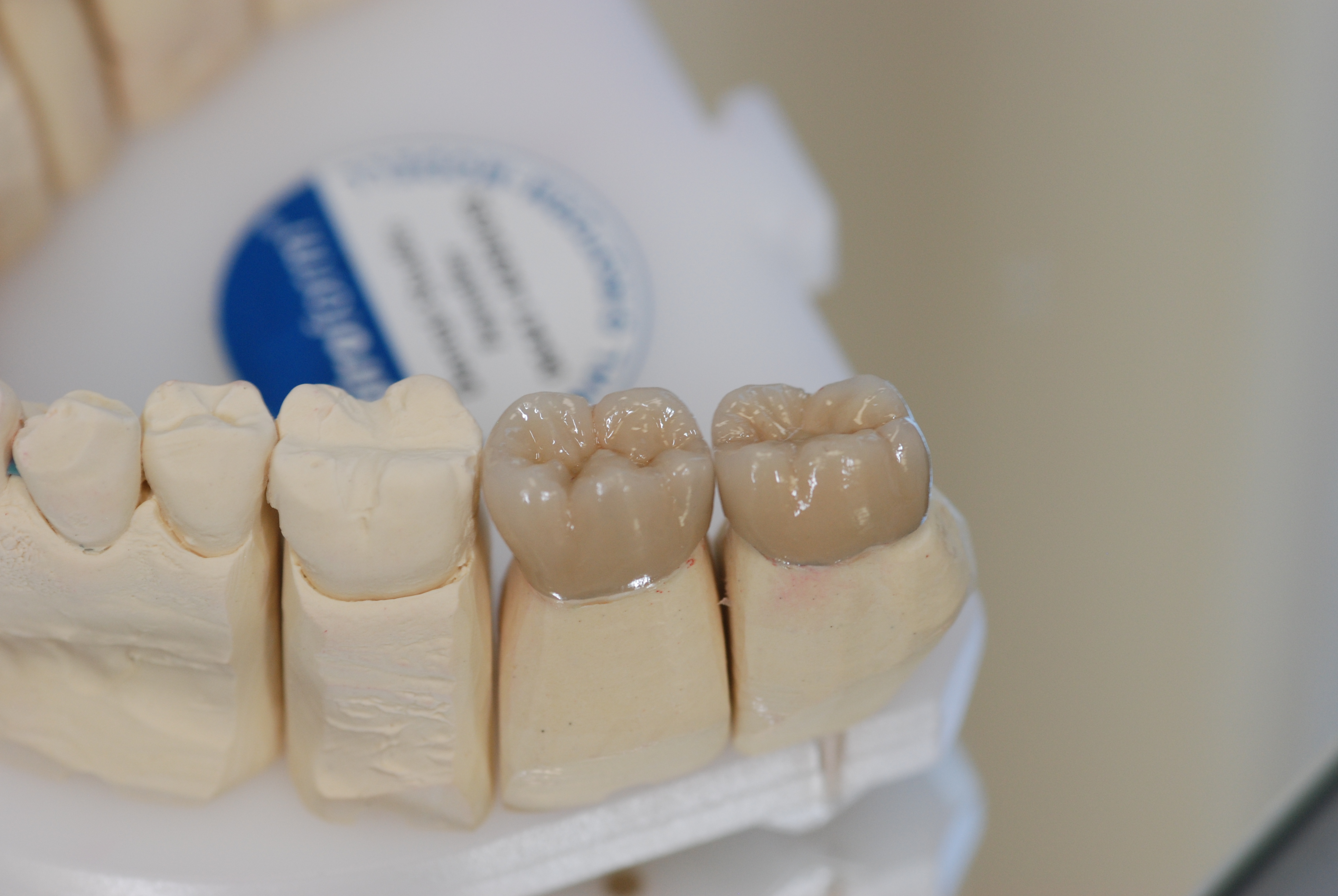 Krone:Vollverblendet | Dental Studio Feindler GmbH