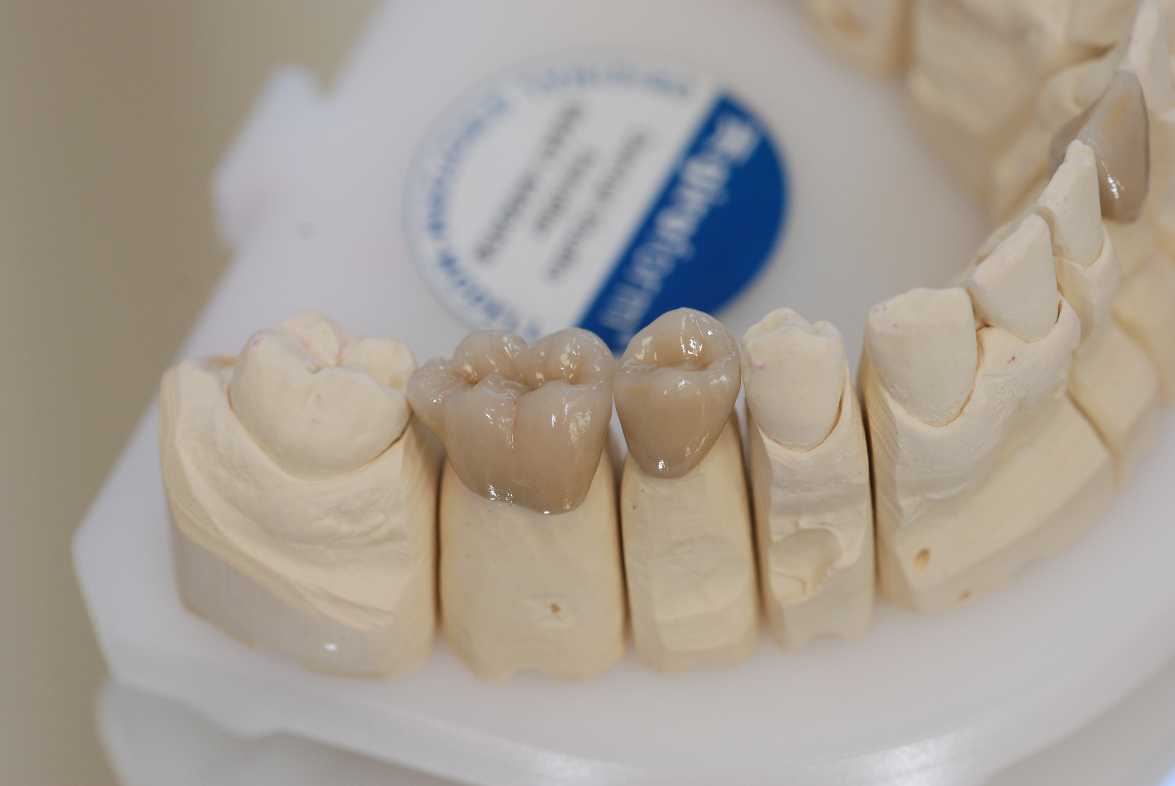 Krone:Vollverblendet | Dental Studio Feindler GmbH