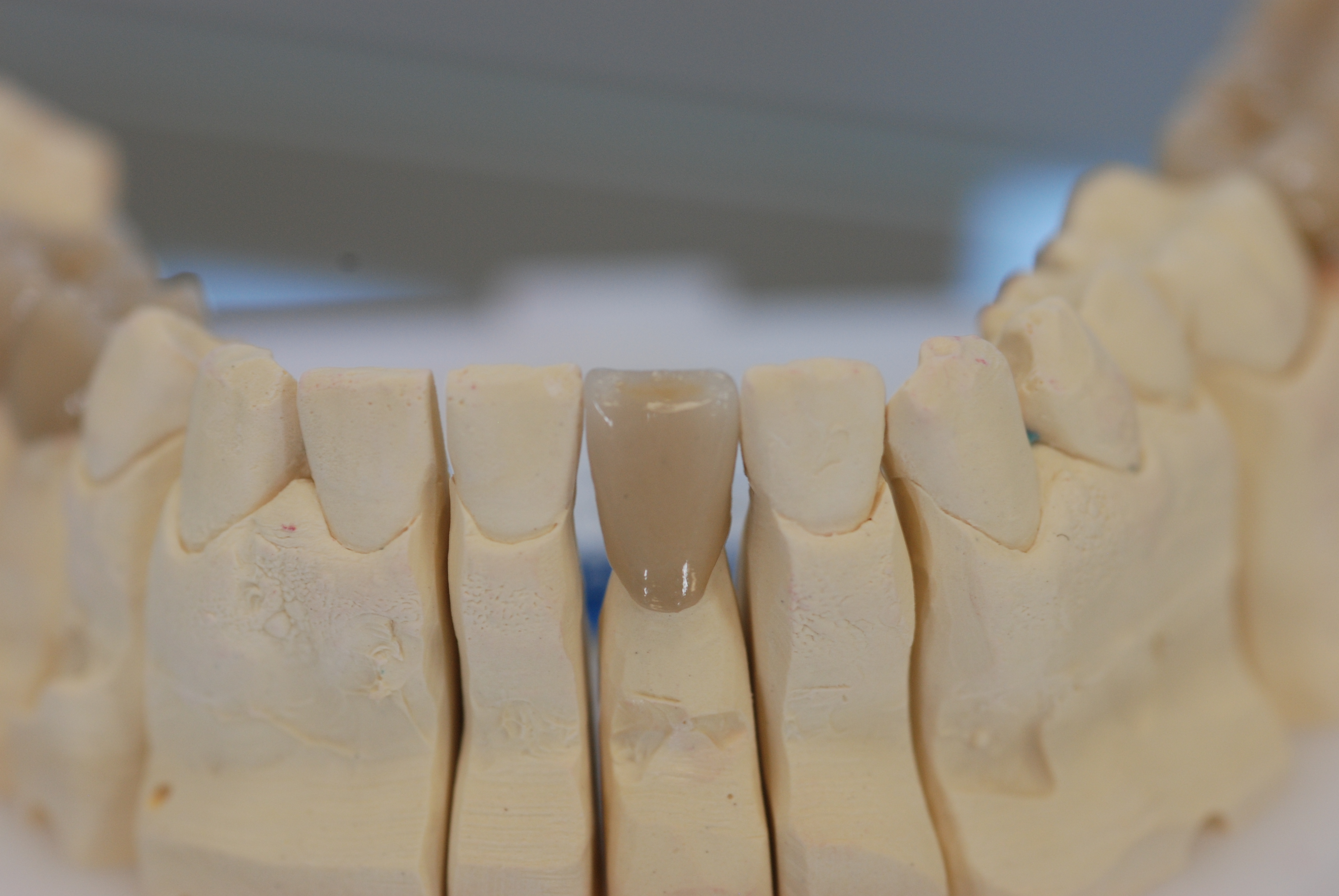 Krone:Vollverblendet | Dental Studio Feindler GmbH